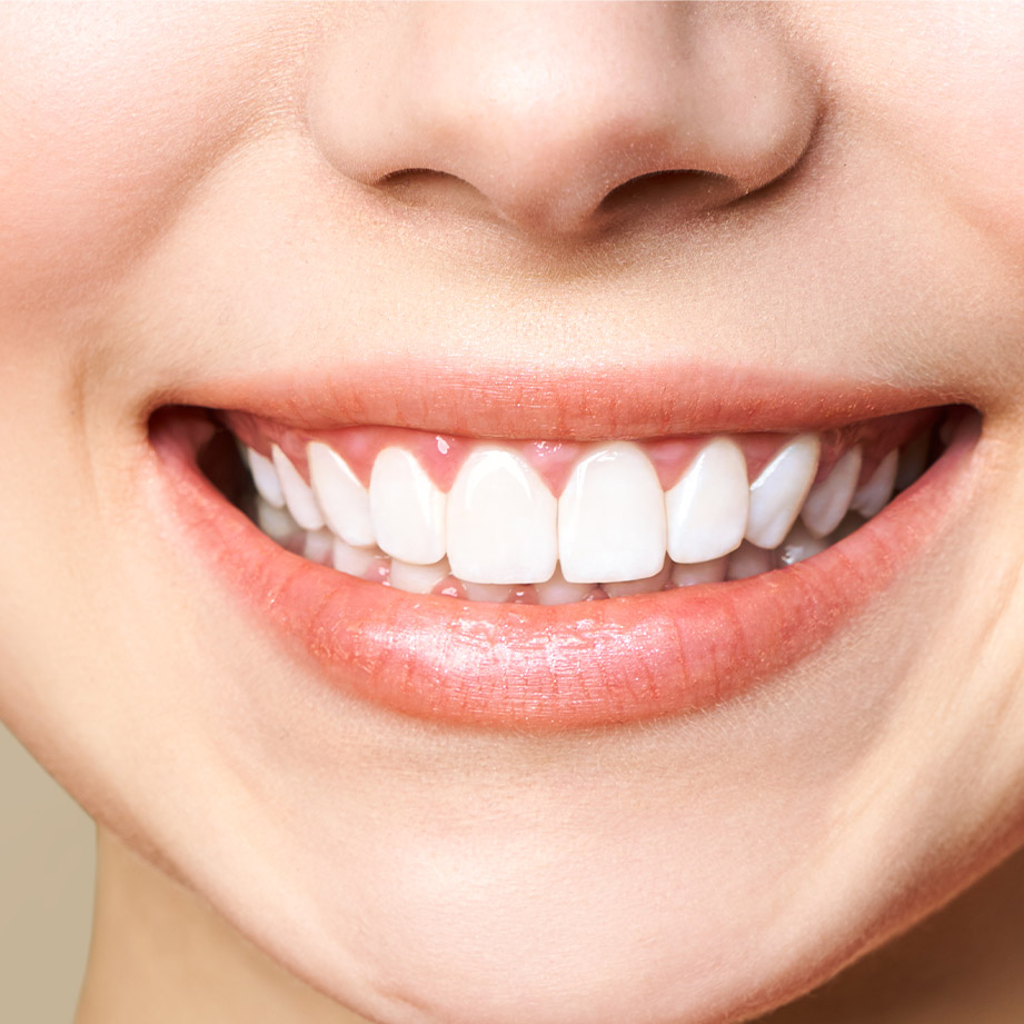 Teeth Whitening - Dental 397 | Dentist in Exeter, Devon