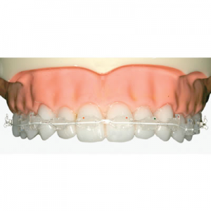 Cfast Invisible Braces – An Overview - Dental 397 | Dentist in Exeter ...